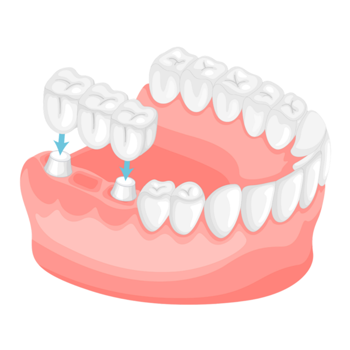 Orthodontic Braces Price | Dentalist Kuala Lumpur