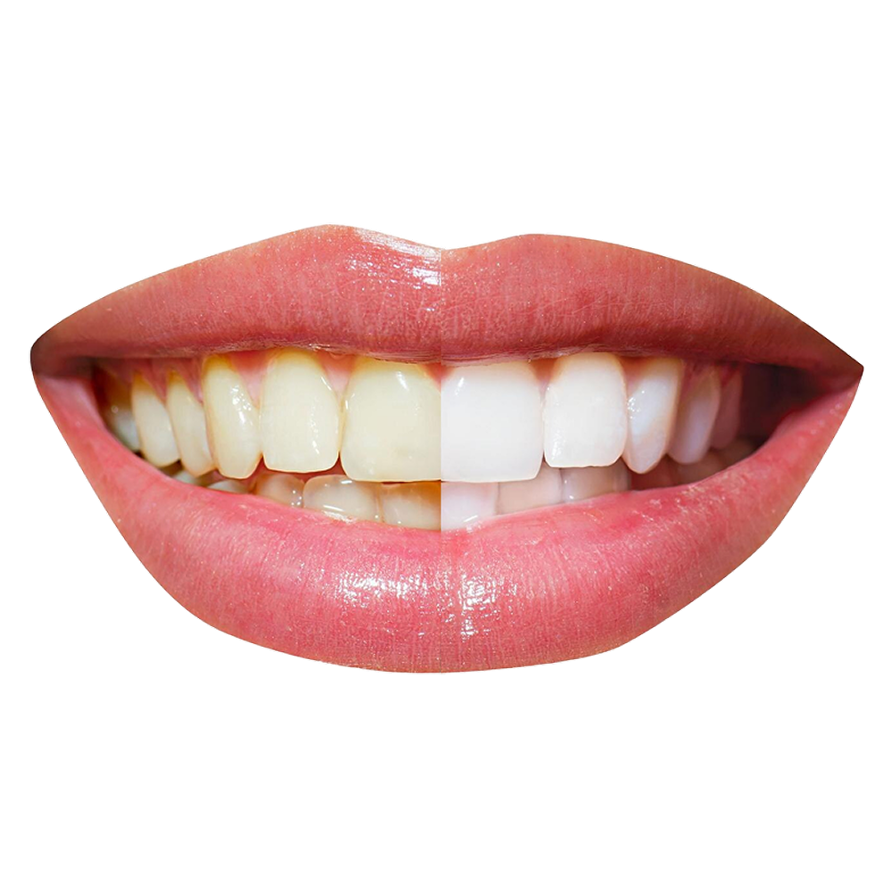 Dental Service Promotion - Scaling & Polishing